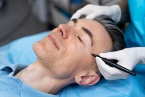 Como Funciona o Lifting Facial Masculino? | Dr. Wendell Uguetto